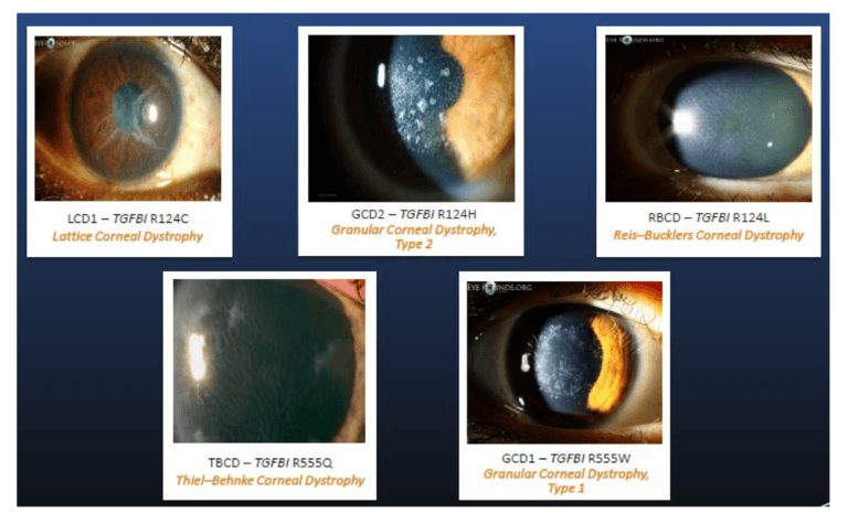 Corneal Dystrophy