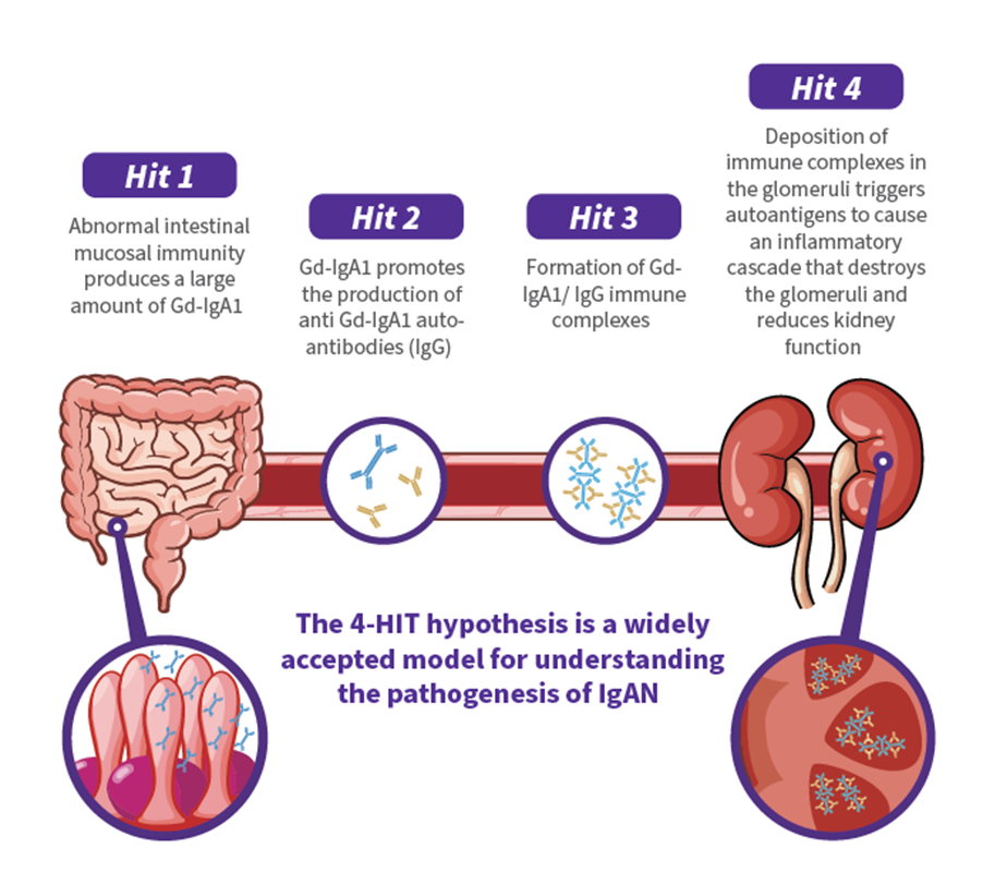 Image Source: Adapted from Suzuki H. Biomarkers for IgA nephropathy on ...